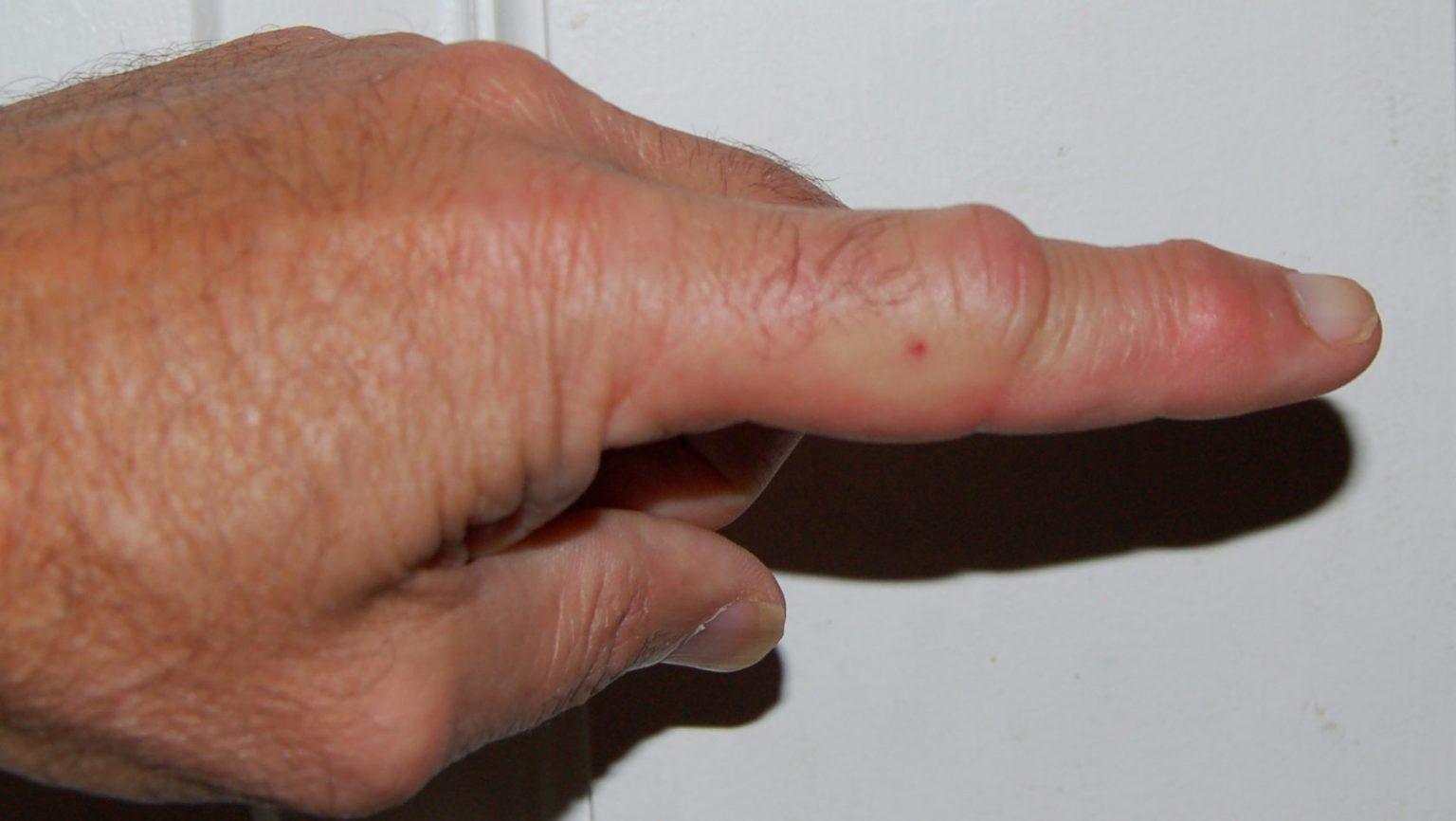 Hornet Sting Treatment: Remedies, First Aid, and Prevention Tips