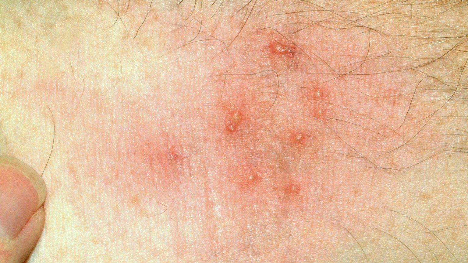 Signs of Mite Infestation: Symptoms & Effective Treatments