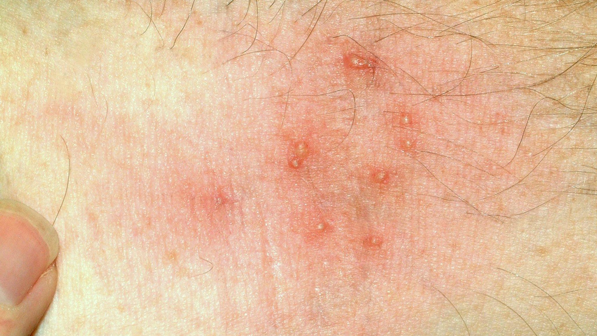 Signs of Mite Infestation: Symptoms & Effective Treatments