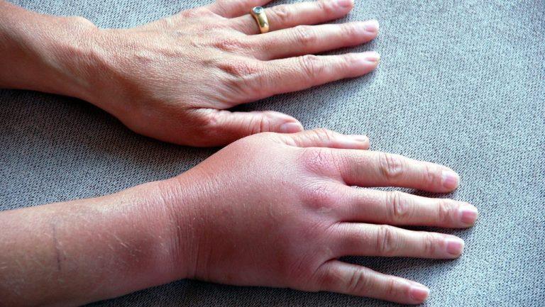 When to Learn About a Yellow Jacket Sting: Health Risks & Signs