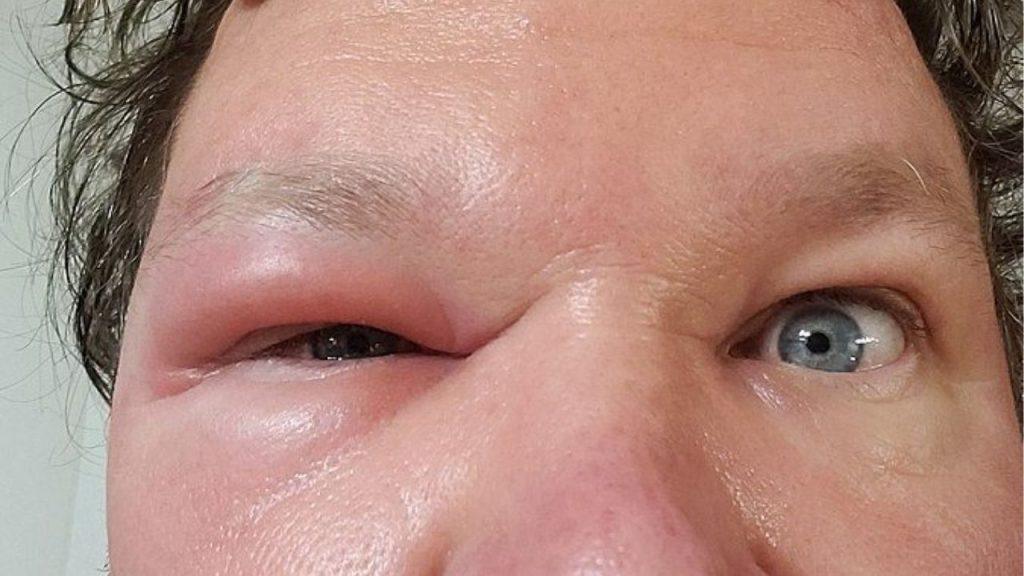 How Different Insect Stings Affect Body | Prevention & Treatments